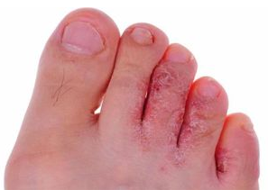 Champignon de pied de traitement - Micinorm